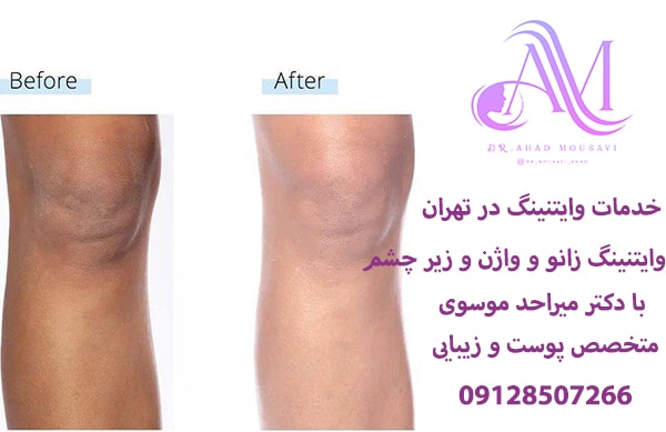 وایتنینگ یا سفید کردن واژن و دور چشم و زیر بغل با متد 2025